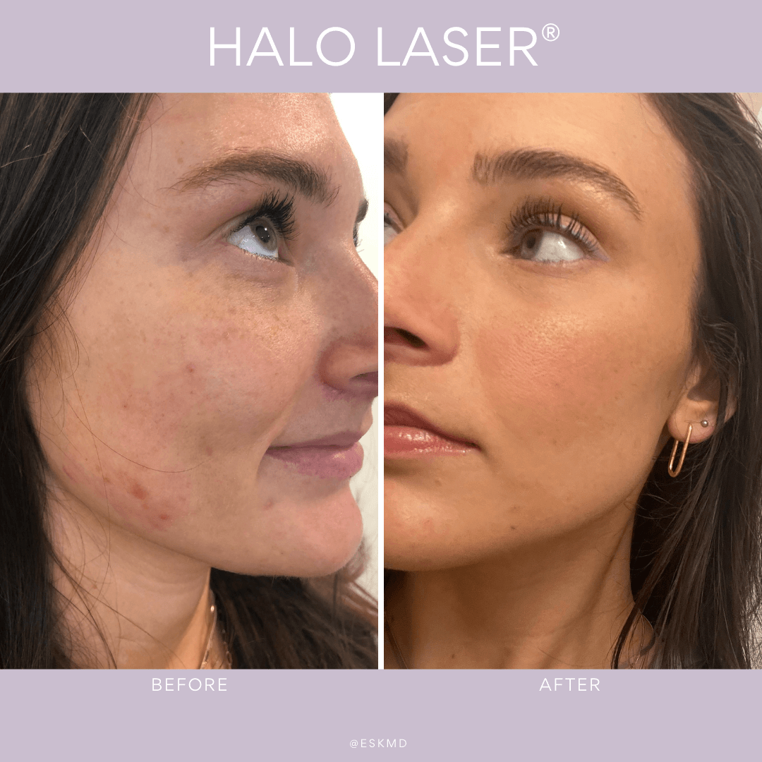 Halo Laser Resurfacing NYC | Halo Laser Treatment New York
