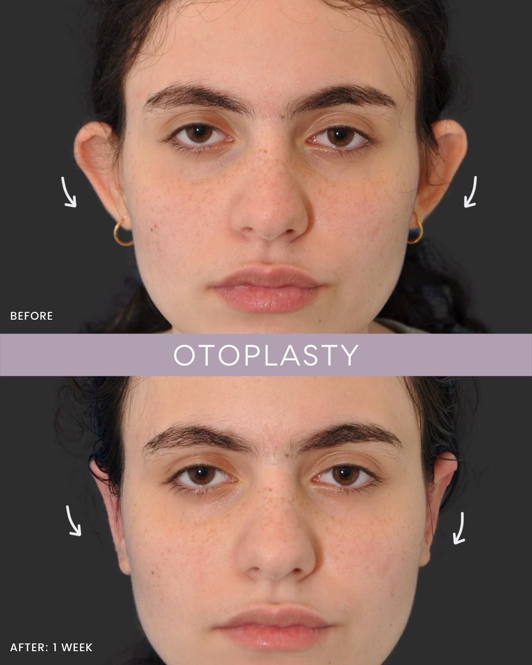 Ear Surgery NYC | Otoplasty Manhattan